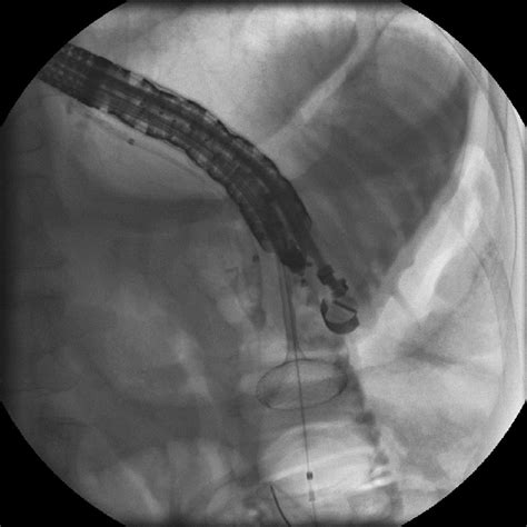 Deployment Of Lumen Apposing Stent Download Scientific Diagram