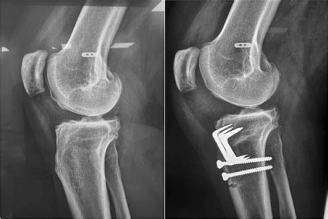 Regarding “anterior Opening Wedge High Tibial Osteotomy In The Setting Of Genu Recurvatum