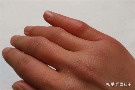 冻疮用什么药？ 知乎