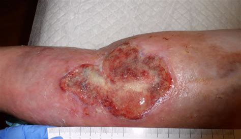 Pyoderma Grangrenosum Caroline Fife Md