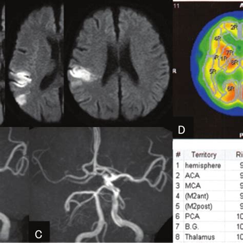A Mri Showed Multiple Infarction Of The Right Cerebral Hemisphere Download Scientific