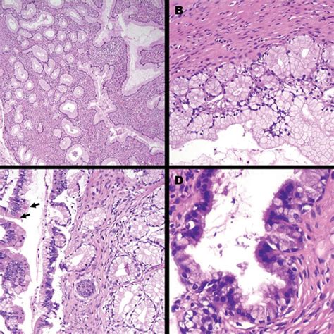 Magnetic Resonance Imaging Mri Demonstrating A Bulky Isthmocele At Download Scientific