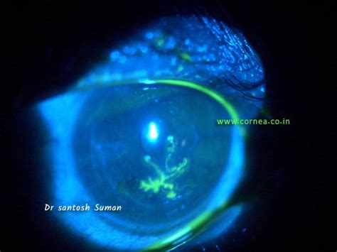 Dendrites Cornea