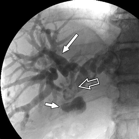 MR Cholangiopancreatography Features Of The Biliary Tree After Liver Transplantation AJR