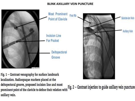 Technic Venous Access For Permanent Pacemaker Implantation Ppt