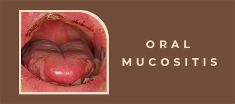 Mucositis Symptoms Oral Findings In Patients With Covid 19 Actas