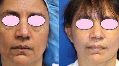 Facial Plastic Surgery Specialists In Orange County Jc Plastic