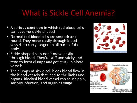 Ppt Sickle Cell Anemia Powerpoint Presentation Free Download Id393020