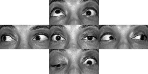 Aberrant Regeneration Of The Third Nerve Oculomotor Synkinesis