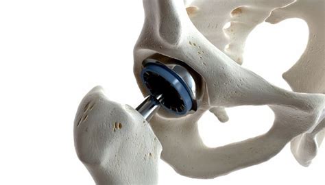 Hip Replacement Surgery In Dubai Total Hip Arthroplasty In Dubai Dr