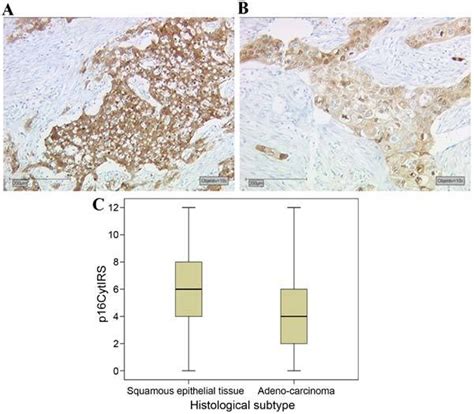 Expression Of P16 In Cervical Cancer Tissues A Squamous Epithelial