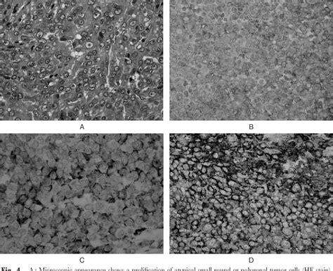 Figure 1 From [a Case Of Proximal Type Epithelioid Sarcoma Of The