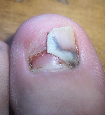 Why Does The Skin Under My Toes Crack Free Gamefinancial