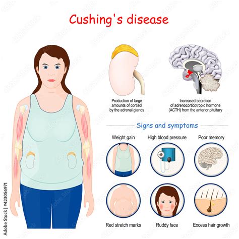 Cushings Disease Signs And Symptoms Of Cushing Syndrome Stock Vector