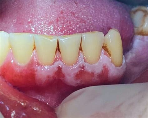 Proliferative Verrucous Leukoplakia A Diagnostic Challenge In A
