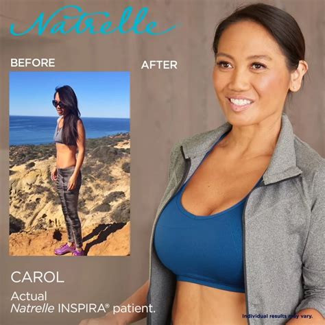 The Allure Of Teardrop Tits Understanding Natural Breast Aesthetics Marin Aesthetics