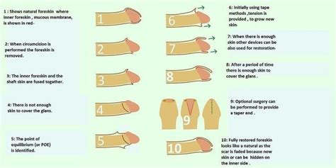 Foreskin Restoration ~ Detailed Information Photos Videos