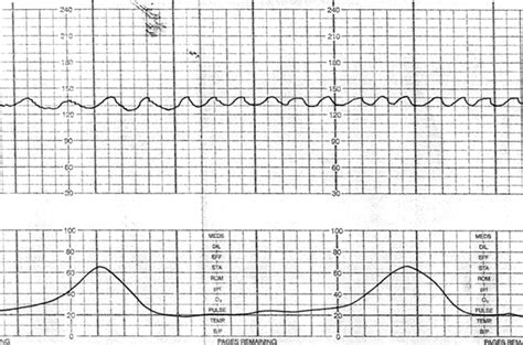 Reactive Fetal Heart Rate Tracing