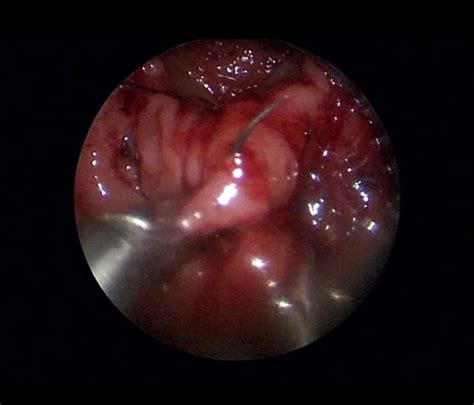Intermittent Suture Of Both Ends Of The Rectal Mucosal Flap Download