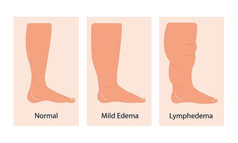 The Stages Of Lymphedema In Legs And Treatment Options Uvvc