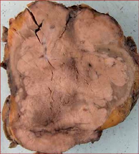 Macroscopic Appearance Of Primary Renal Primitive Neuroectodermal Tumor Download Scientific