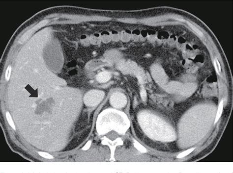 Figure 1 From Liver Abscess Caused By Edwardsiella Tarda A Case Report Semantic Scholar