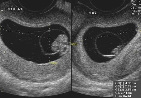 Amniotic Sac Ultrasound