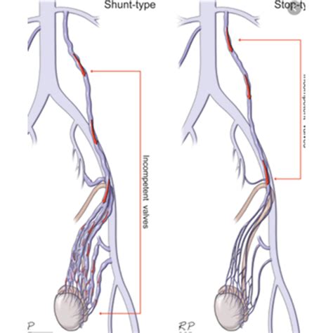 Embolisation For Varicoceles Pkliandrc