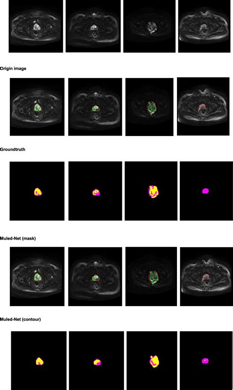 Figure 1 From Prostate Segmentation In Mri Using Transformer Encoder