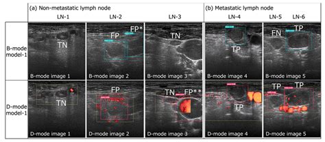 Successful And Unsuccessful Examples Of Metastatic Lymph Node Detection Download Scientific