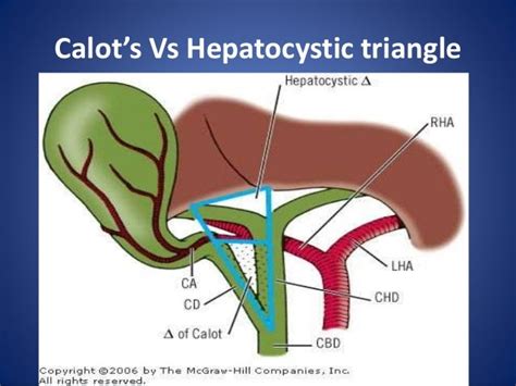 Safe Laparoscopic Cholecystectomy Finale