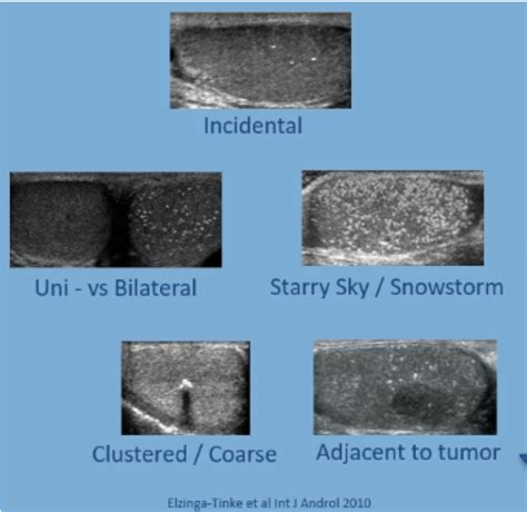 Urotoday How To Manage Testicular Microlithiasis And Facebook