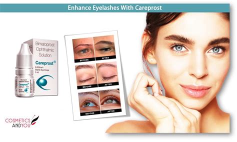 Enhance Eyelashes With Careprost Cosmetics And You Acne Treatment