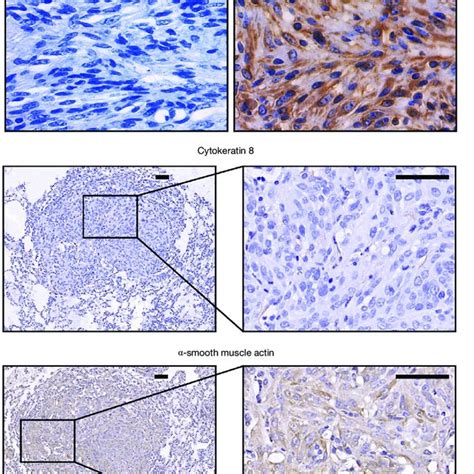 Histopathological Analysis Identified The Sarcomas As Aggressive Soft Download Scientific
