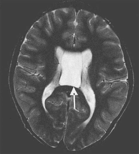 透明隔发育异常 Mri磁共振成像原理与临床