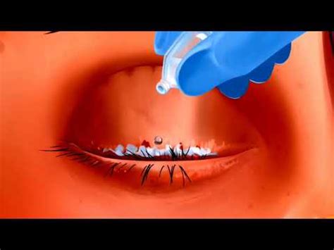 Popping Eye Pimples Asmr Satisfying Treatment Eye Pimples Asmr Treatment Pimples On Eyebrow