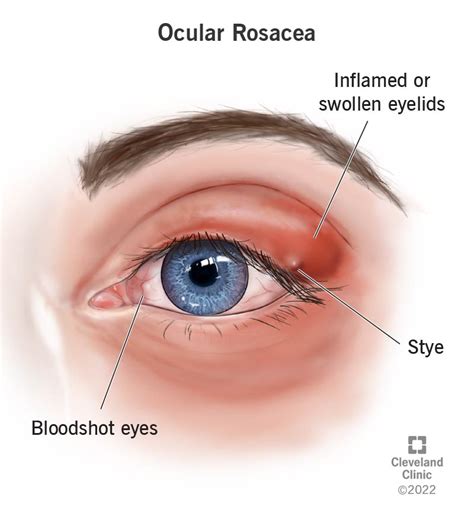 Acne Rosacea Eyes