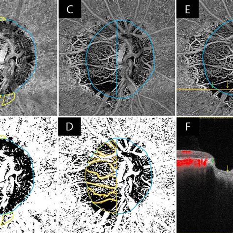 Measurements Of Parapapillary Choroidal Vessel Density Vd And Download Scientific Diagram