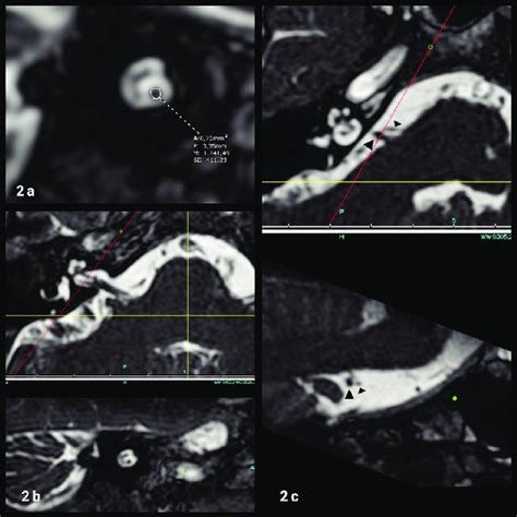A Cochlear Nerve Measurements In Sagittal Mpr Fiesta Image Free Hand Download Scientific