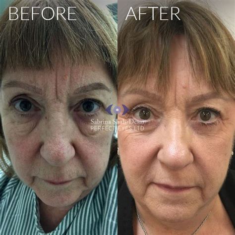 Eye Bags Removal Surgery Before And After At Rick Weiss Blog