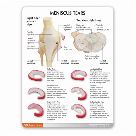 Knee Joint Wmeniscus Tear Model Human Body Anatomy Replica Of Knee