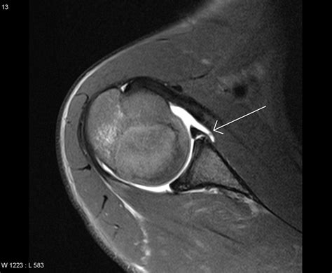 Anatomy Of Labrum At Harry Brawner Blog