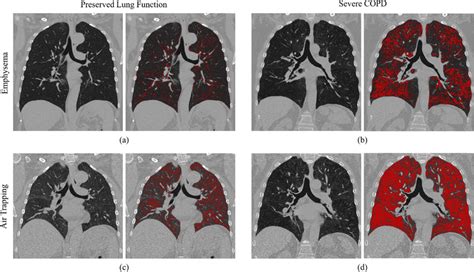 Illustrations Of Emphysema And Air Trapping On Chest Ct Images A Download Scientific Diagram