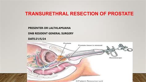Transurethral Resection Of Prostatepptx