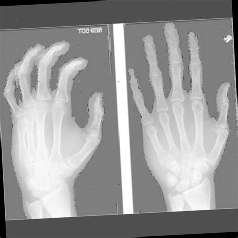 How To Use The Fracture Detection Object Detection Api