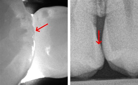 Interproximal Initial Caries Treated With Curodont Repair And Curodont Protect Vvardis