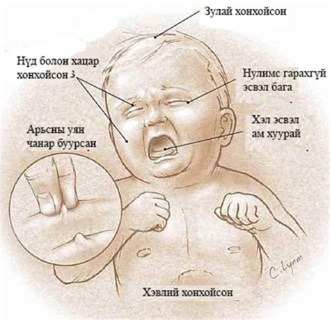 Суулгалт өвчний илрэх шинж тэмдэг урьдчилан сэргийлэх аргууд News Mn