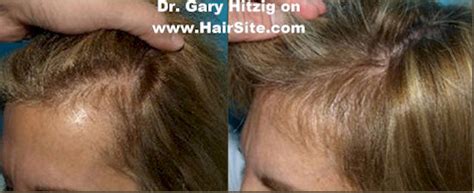 Acell Matristem Hair Treatment