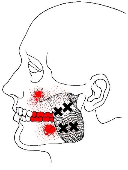 Masseter Trigger Points And Referred Pain Patterns