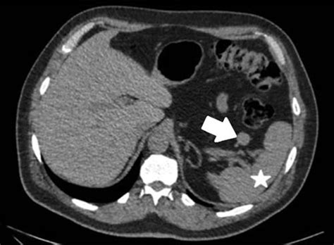 Ct Scan Of Accessory Spleen At Splenic Hilus Accessory Spleen Arrow Download Scientific